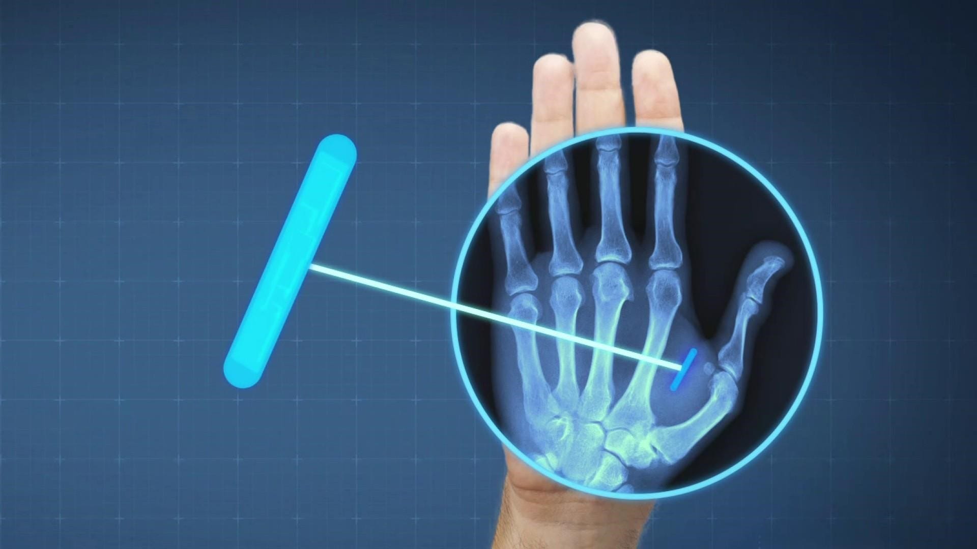 Get Identity Chips Implanted Under The Skin - Should or Not? - FinanceBuzz!